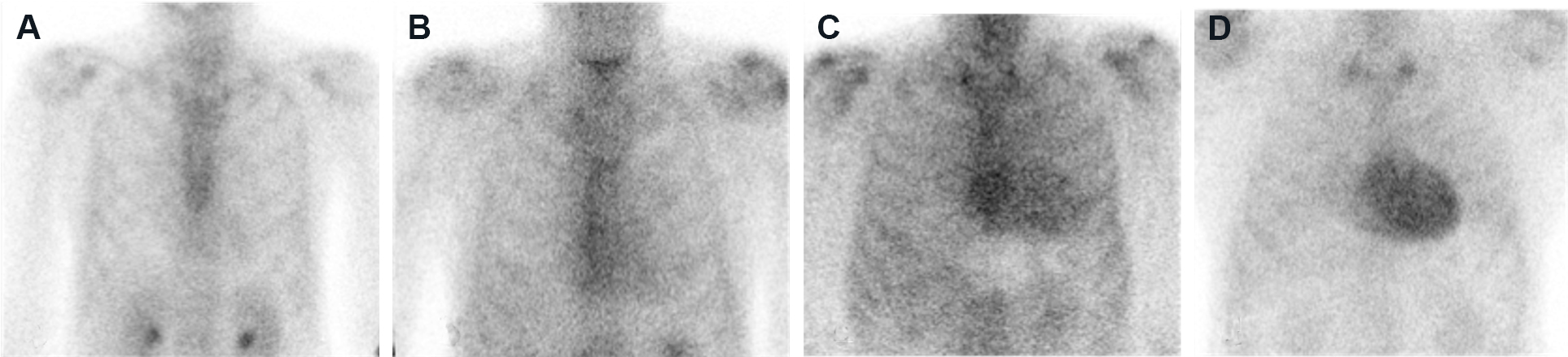 Clinical Application Of Cardiac Scintigraphy With Bone Tracers