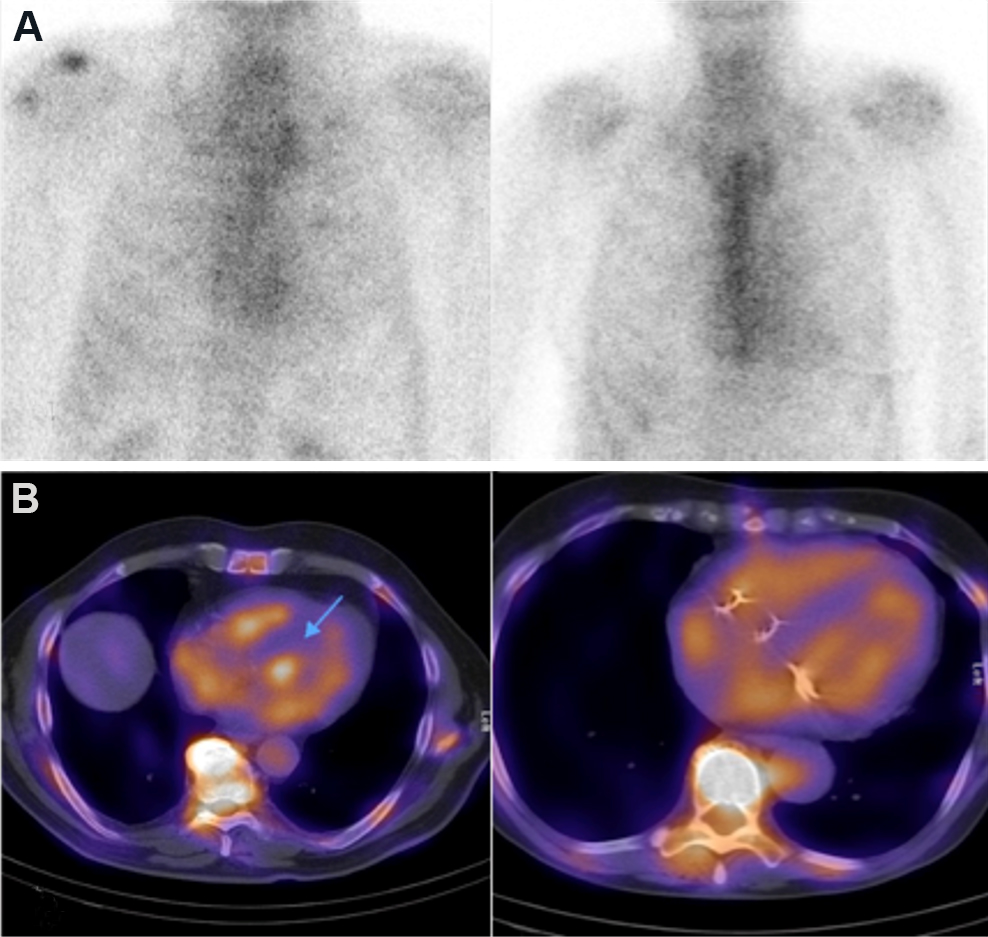 Clinical application of cardiac scintigraphy with bone tracers ...