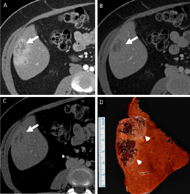 CT of hepatocellular carcinoma in non-alcoholic fatty liver disease ...
