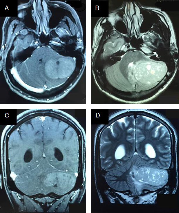 Medulloblastoma Mri