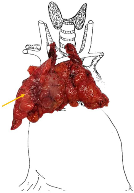 Standardized definitions and concepts of radicality during minimally ...