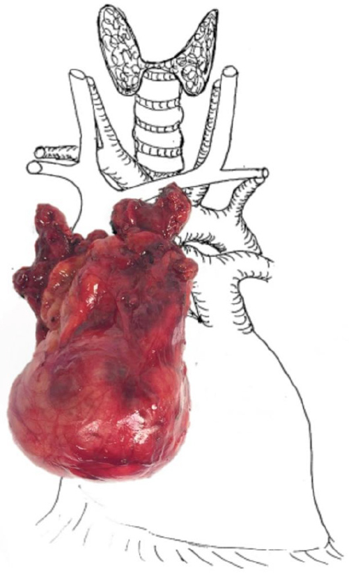 Standardized definitions and concepts of radicality during minimally invasive thymoma resection