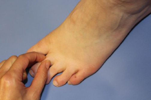 Differential diagnoses and treatment of lipedema