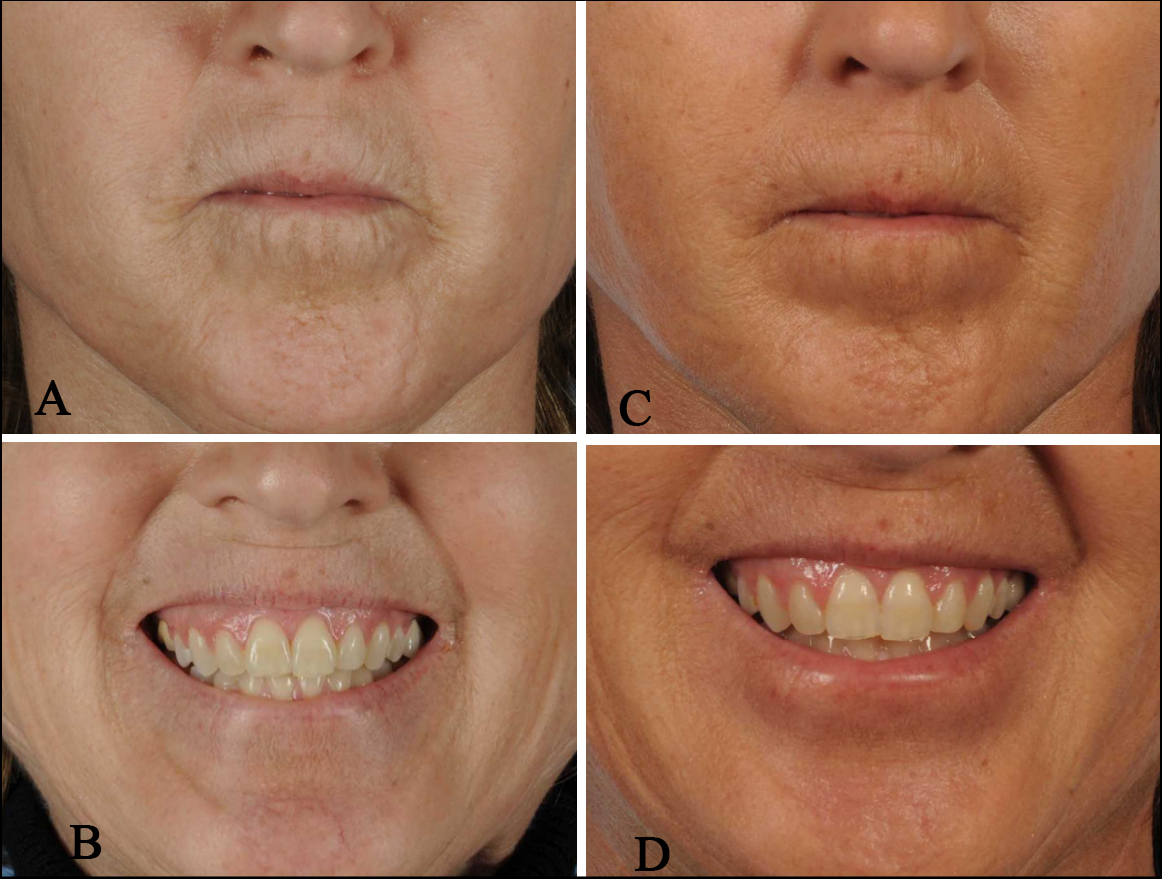 Systemic Scleroderma Face