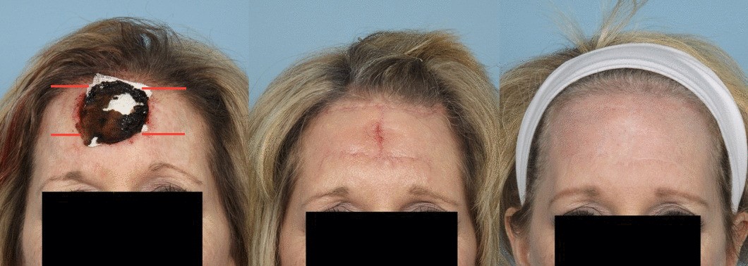Scalp reconstructive flaps